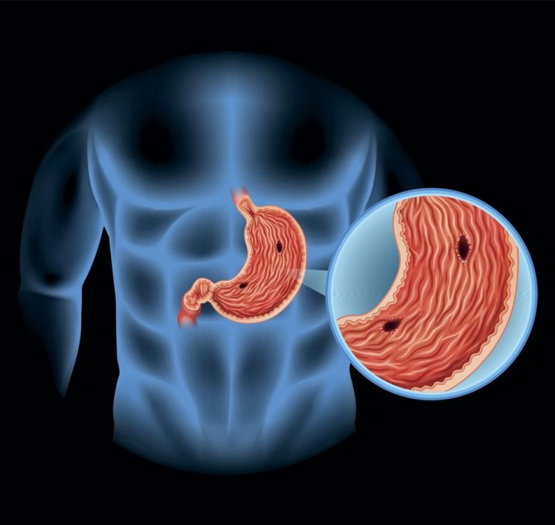 Ulcers – Digestive Disease Associates, LTD. – Hinsdale